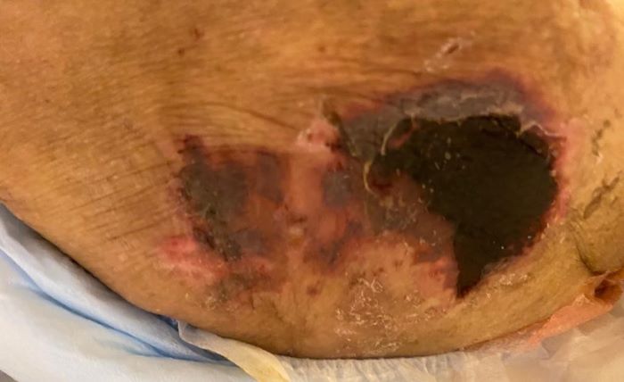 Understanding Kennedy Terminal Ulcers, Other End-of-Life Skin Changes ...